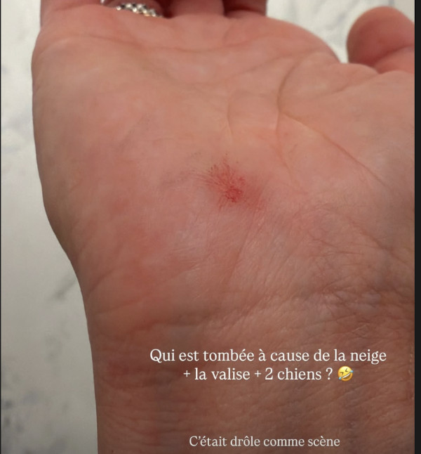 Iris Mittenaere blessée après une chute mémorable à Paris